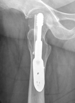 Fixation | The Bone School